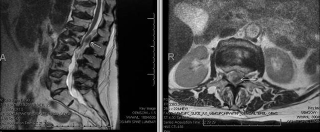 Lumbar Epidural Hematoma after Neuraxial Pain Procedure in a Patient ...